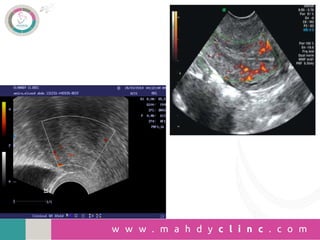 Ovulation induction | PPT