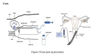Ovum pick up (opu) | PPTX