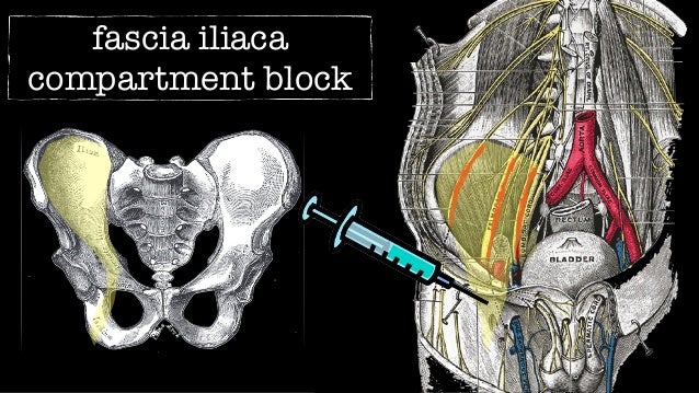 Iliaca