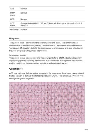 oxfordmedicaleducation.com-ECG EKG examples and quiz.pdf
