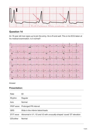 oxfordmedicaleducation.com-ECG EKG examples and quiz.pdf