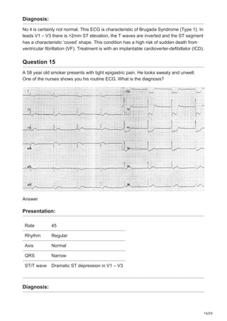 oxfordmedicaleducation.com-ECG EKG examples and quiz.pdf