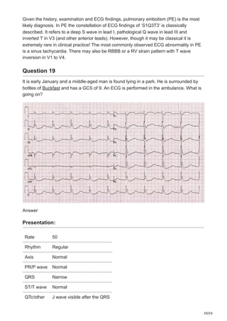 oxfordmedicaleducation.com-ECG EKG examples and quiz.pdf