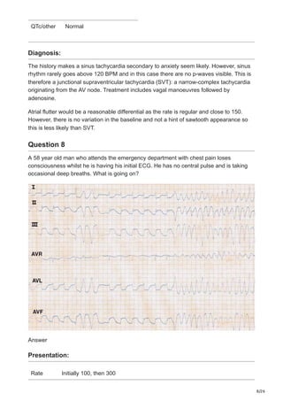 oxfordmedicaleducation.com-ECG EKG examples and quiz.pdf