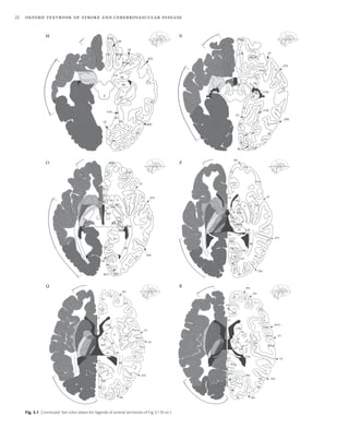 Oxford textbook of stroke and cerebrovascular disease ( PDFDrive ).pdf