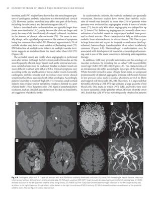 Oxford textbook of stroke and cerebrovascular disease ( PDFDrive ).pdf