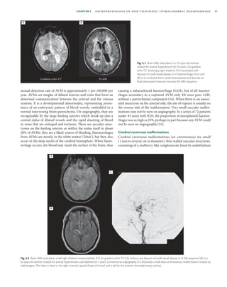 Oxford textbook of stroke and cerebrovascular disease ( PDFDrive ).pdf