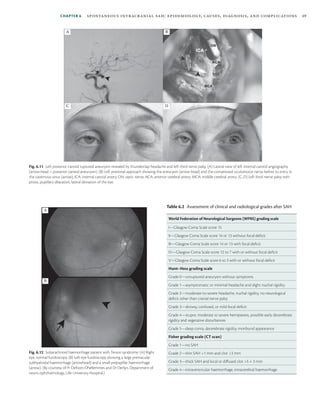 Oxford textbook of stroke and cerebrovascular disease ( PDFDrive ).pdf