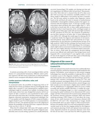 Oxford textbook of stroke and cerebrovascular disease ( PDFDrive ).pdf