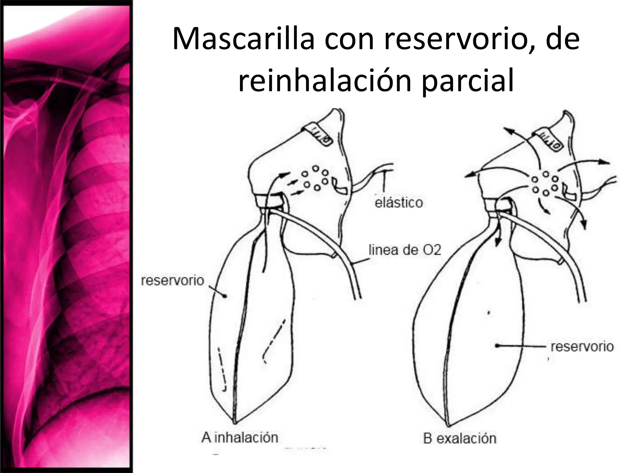 oxigenoterapia de bajo y alto flujo dispositivos | PPT
