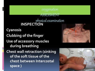 Oxygenation nursing process | PPTX
