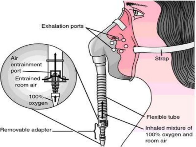 Oxygen delivery devices | PPTX | Ear, Nose and Throat Conditions ...