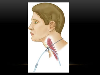 Transtracheal Oxygen