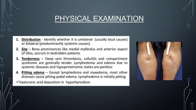 Edema and it's types ( presentation ) medicine | PDF