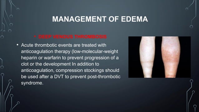 Edema and it's types ( presentation ) medicine | PDF