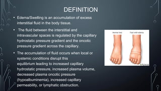 Edema and it's types ( presentation ) medicine | PDF