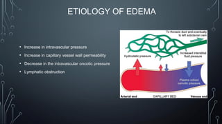 Edema and it's types ( presentation ) medicine | PDF