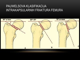 Ozljede kuka i natkoljenice | PPT