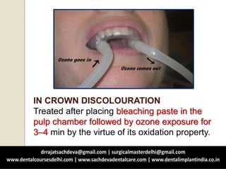 Ozone and its applications in dentistry | PPTX