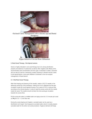 Ozone therapy in the dentistry | DOCX
