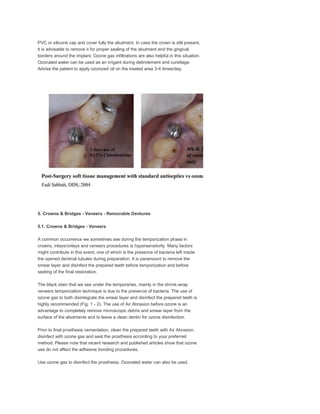 Ozone therapy in the dentistry | DOCX