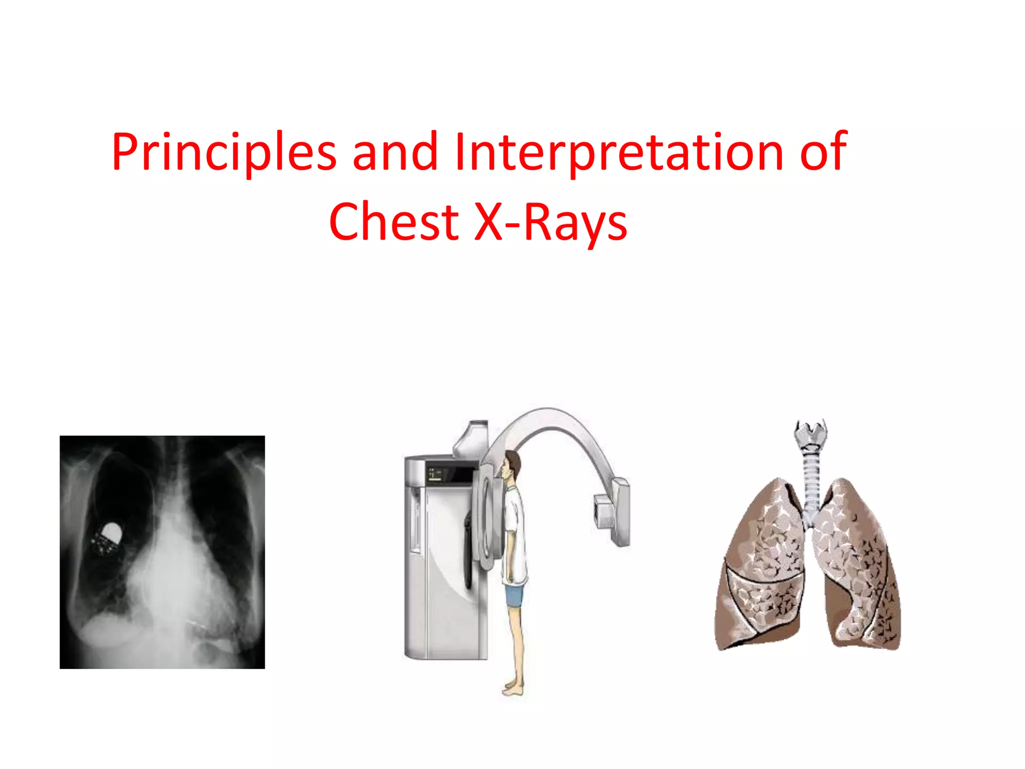 basic_chest_x_ray_.ppt