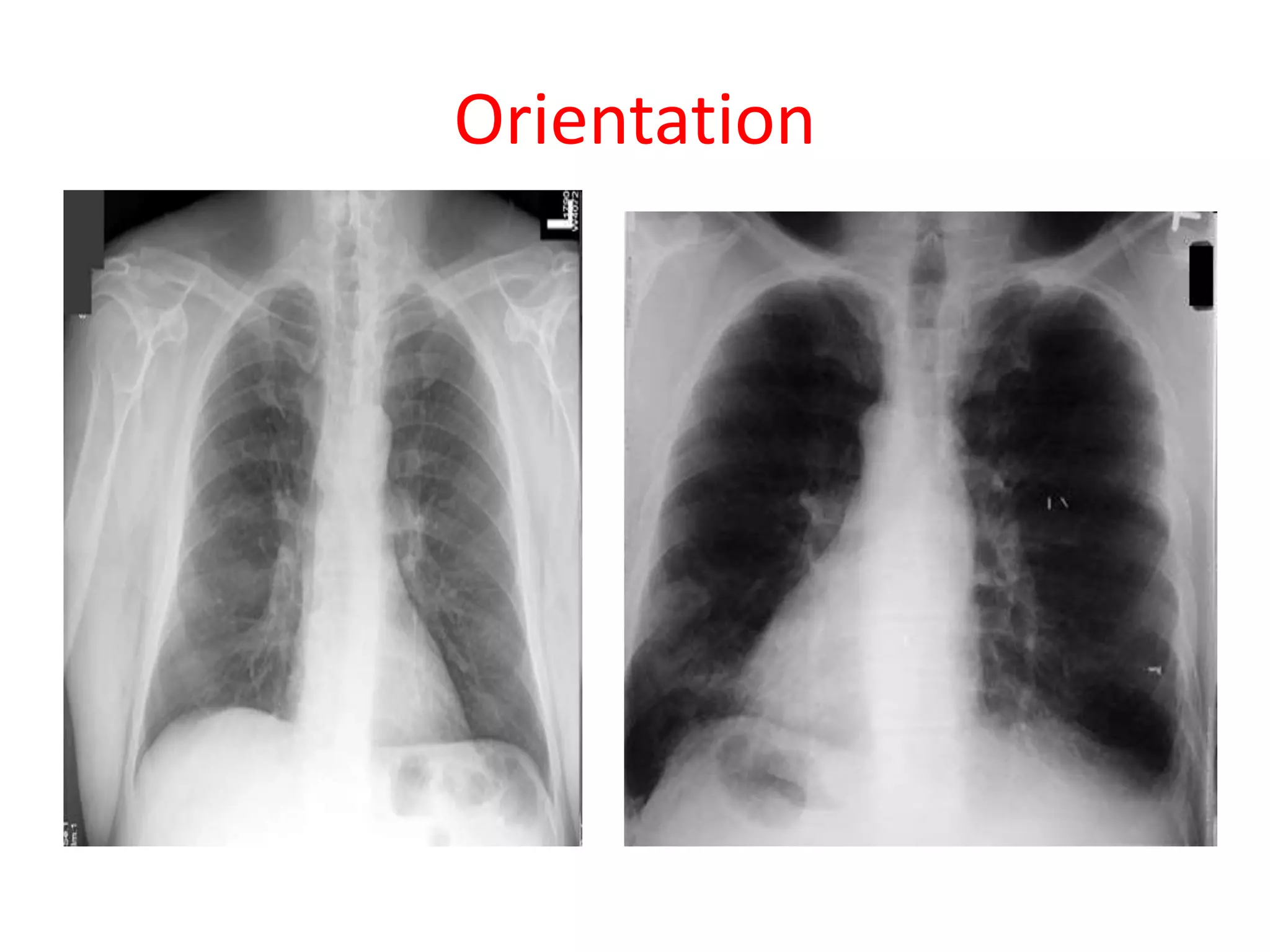 basic_chest_x_ray_.ppt | Lung and Respiratory Health | Diseases and ...