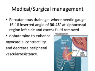 pericardial effusion, cardiac tamponade and myocardial rupture | PPTX
