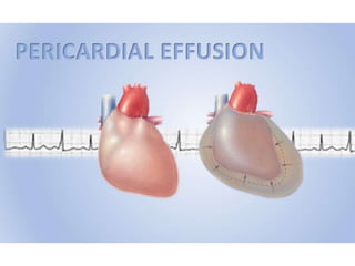 pericardial effusion, cardiac tamponade and myocardial rupture | PPTX
