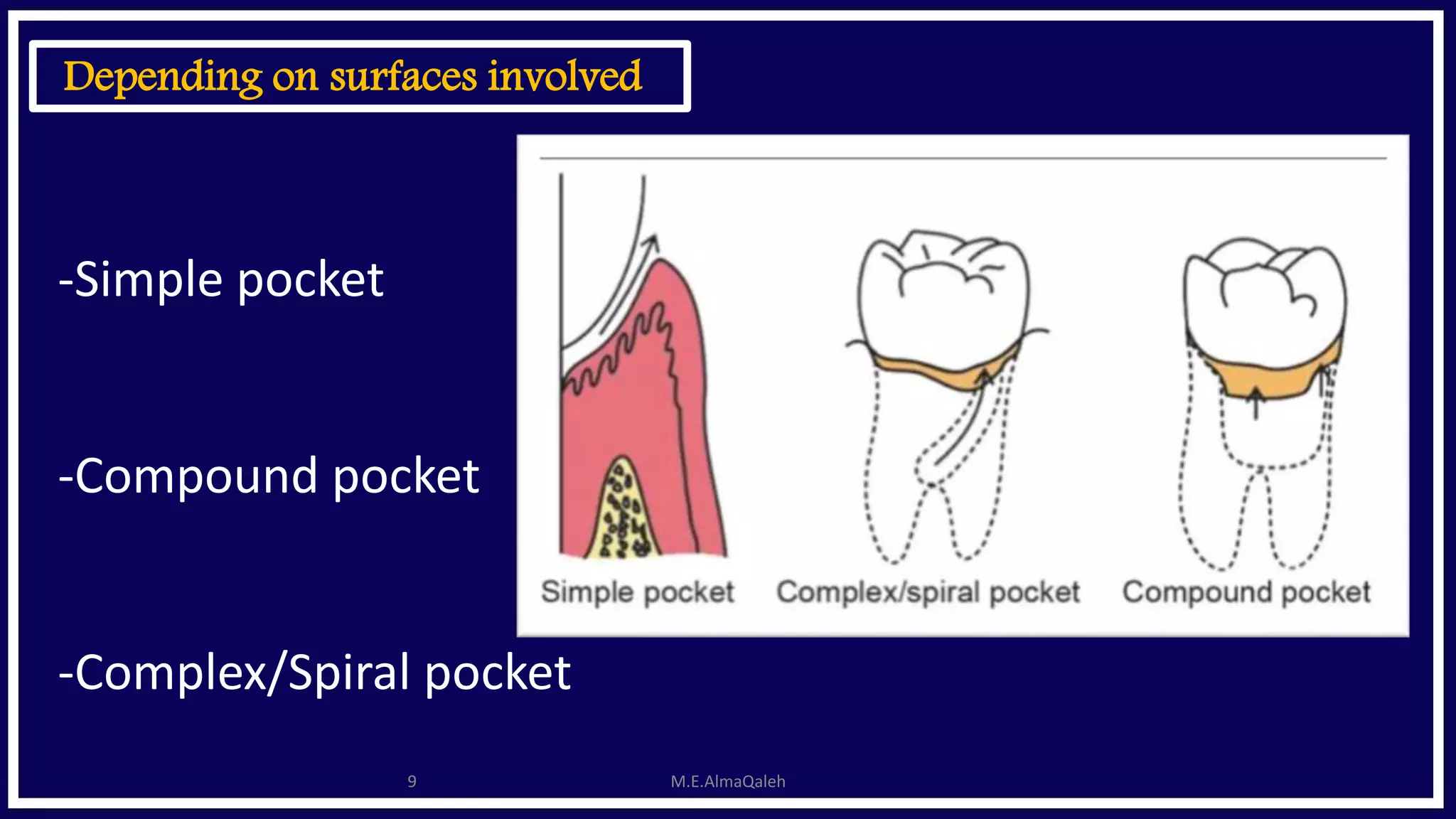 Periodontal Pocket | PDF