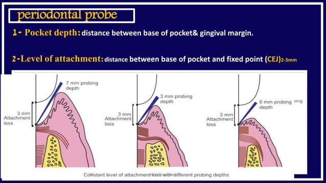 Periodontal Pocket | PDF | Oral care | Personal Care