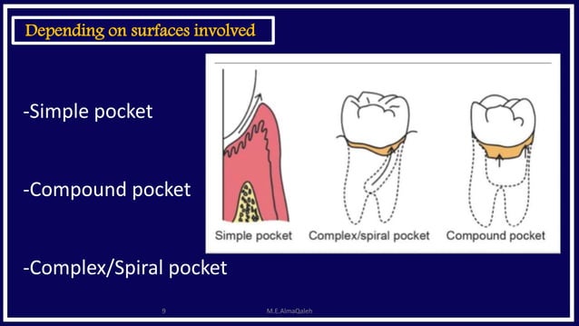 Periodontal Pocket | PDF | Oral care | Personal Care