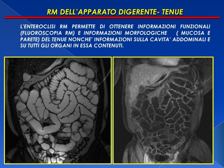 P.cerro.diagnostica radiologica nel m. di crohn