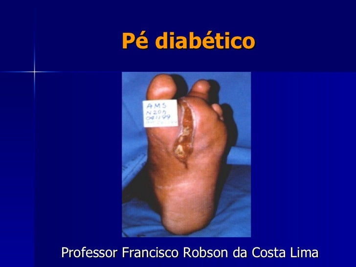 Pé Diabético