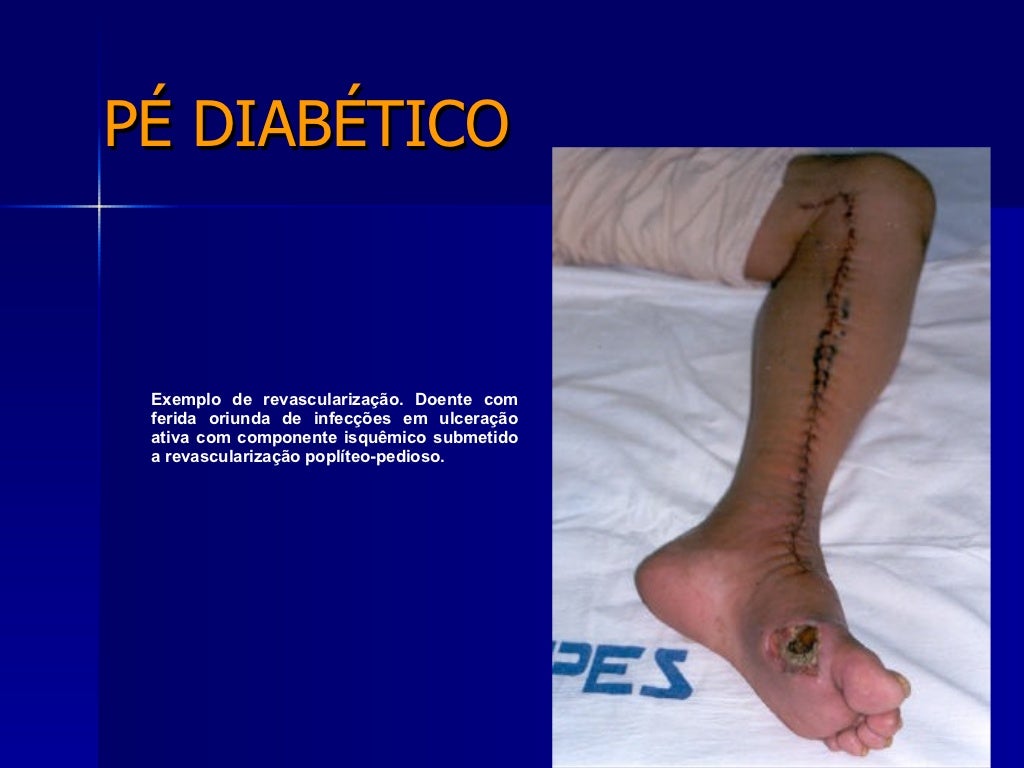 Pé Diabético
