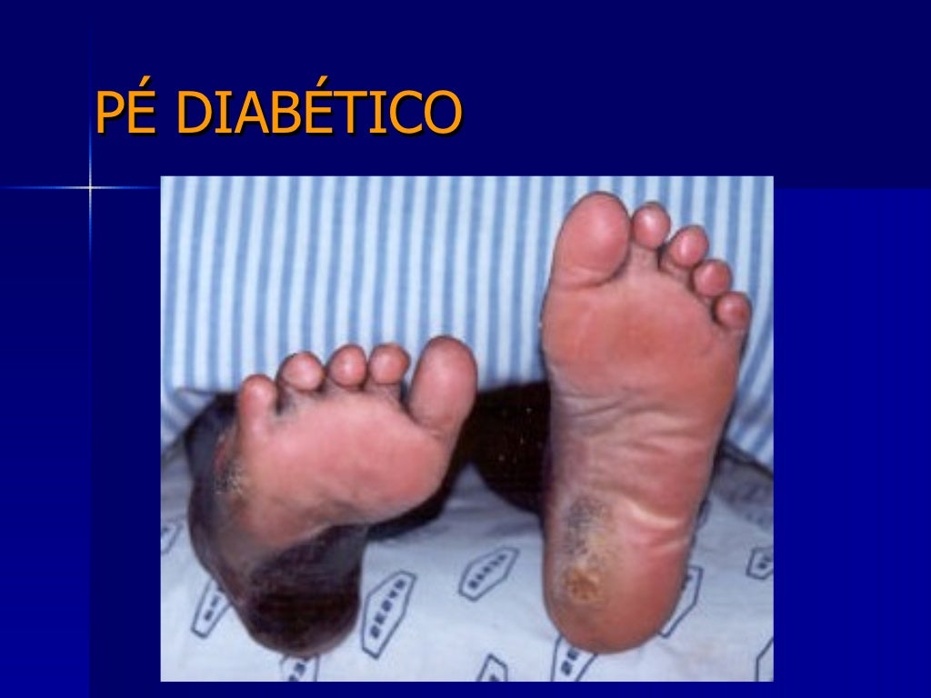 Pé Diabético