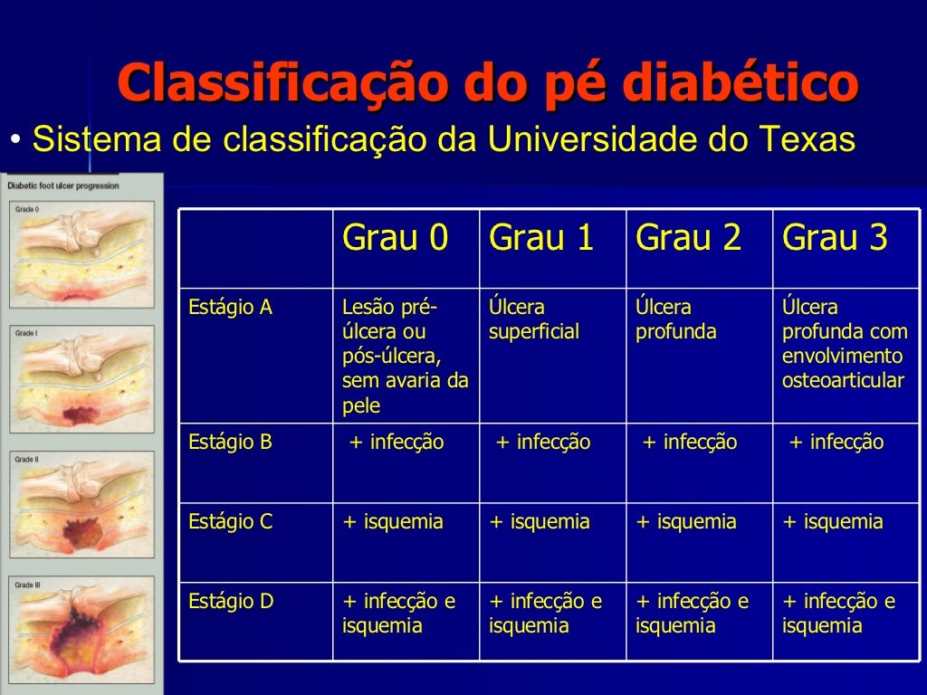 Pé Diabético
