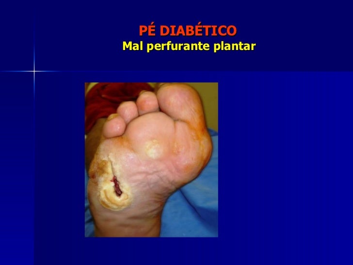 Pé Diabético
