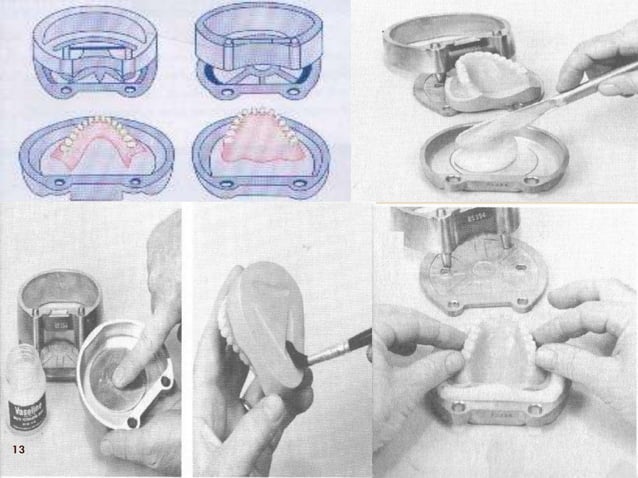 Removeable Partial Denture Steps | PPTX | Dental Health | Diseases and ...