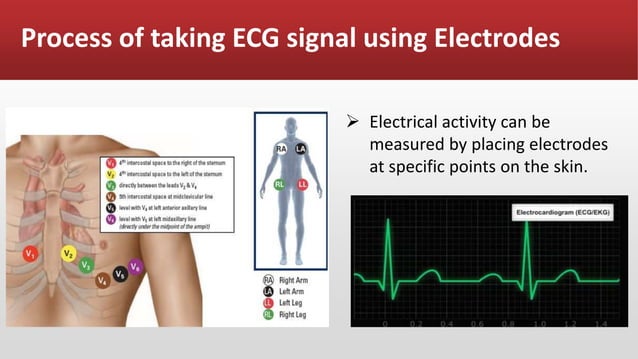 P-QRS-T peak detection of ECG signal by MATLAB | PPTX | Heart and Cardiovascular Diseases ...