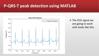P-QRS-T peak detection of ECG signal by MATLAB | PPTX