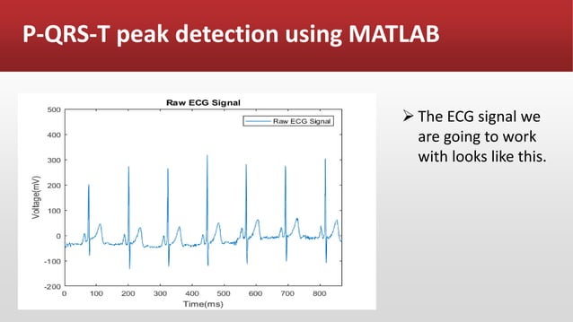 P Qrs T Peak Detection Of Ecg Signal By Matlab Pptx Heart And Cardiovascular Diseases