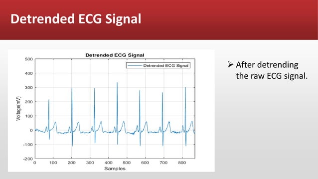 P-QRS-T peak detection of ECG signal by MATLAB | PPTX | Heart and Cardiovascular Diseases ...