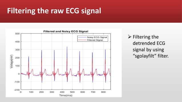 P-QRS-T peak detection of ECG signal by MATLAB | PPTX | Heart and Cardiovascular Diseases ...
