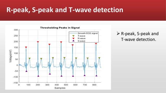 P-QRS-T peak detection of ECG signal by MATLAB | PPTX | Heart and Cardiovascular Diseases ...