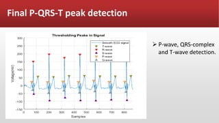 P-QRS-T peak detection of ECG signal by MATLAB | PPTX