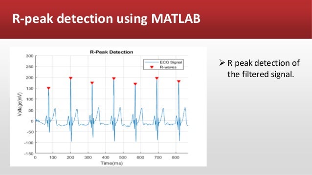 P Qrs T Peak Detection Of Ecg Signal By Matlab