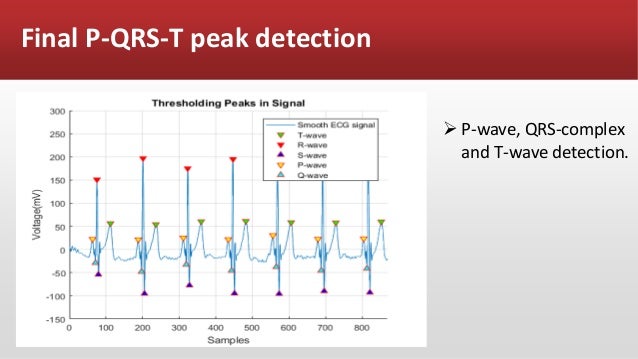 P-QRS-T peak detection of ECG signal by MATLAB