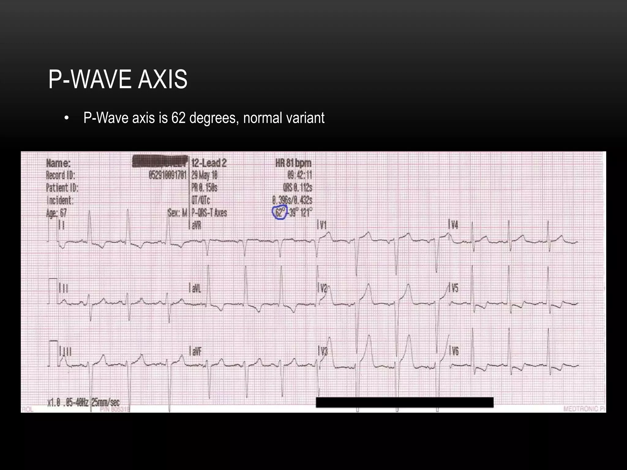 P wave axis and escape rhythms | PPTX