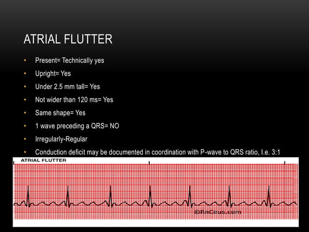P wave axis and escape rhythms | PPT